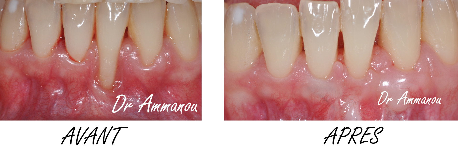 Greffes de gencive Le Perreux sur Marne (94170) | Dr Terence Ammanou ...
